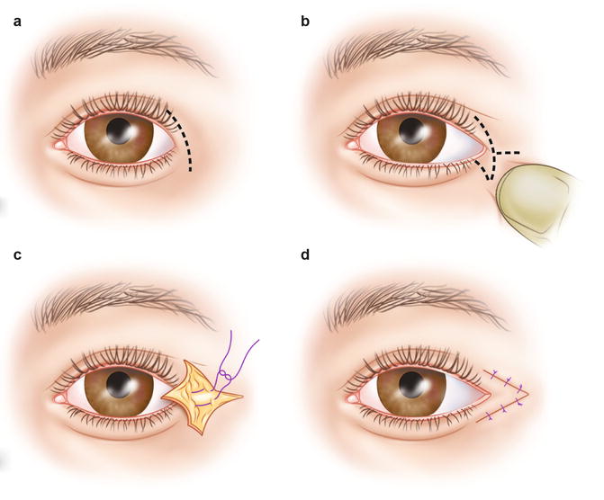 Canthopexy - Cares For You